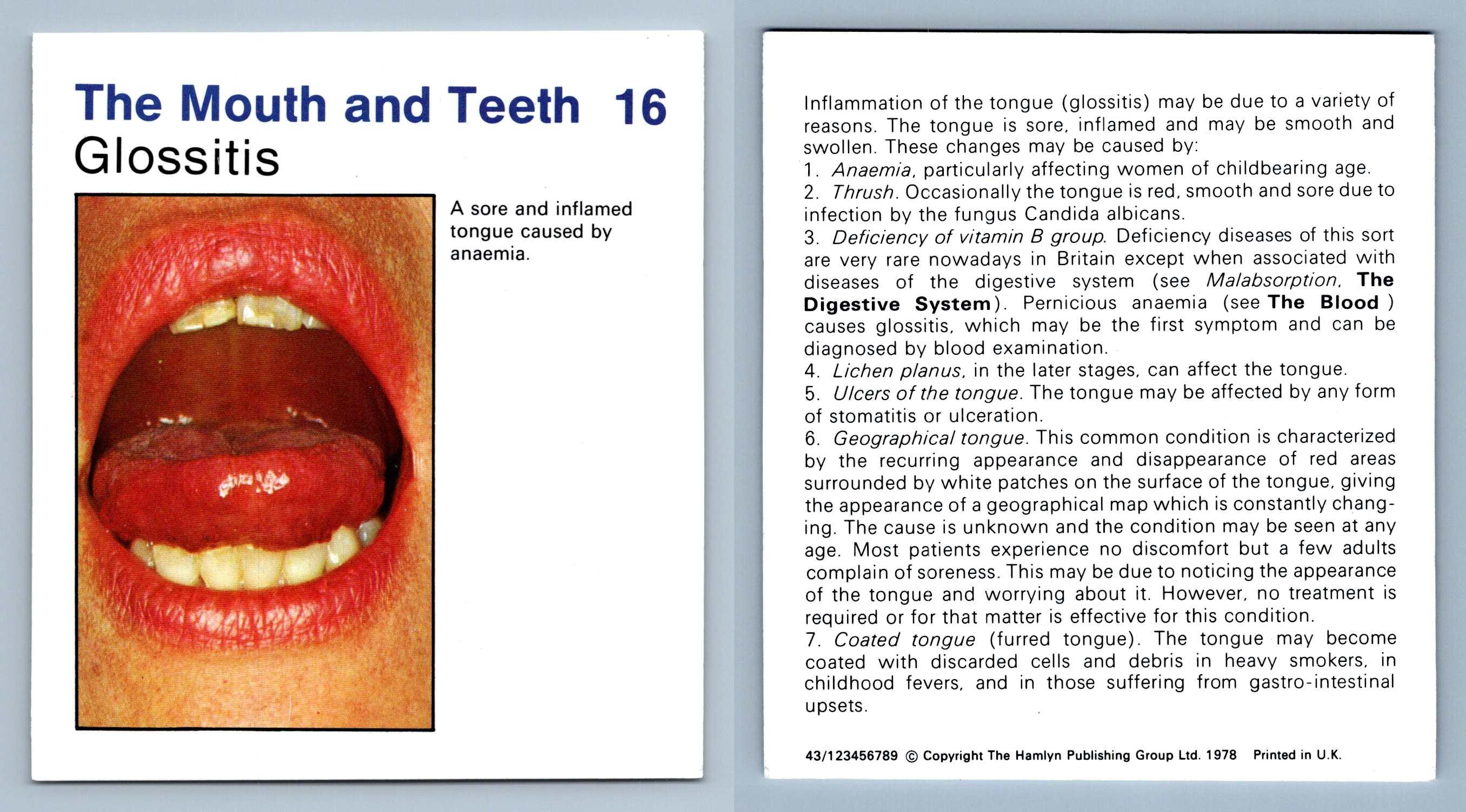 Glossitis #16 Mouth & Teeth Home Medical Guide 1975-8 Hamlyn Card