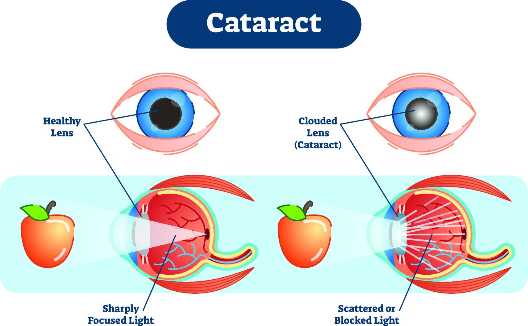 Cataracts: Causes, Symptoms & Treatment | Glasses2You