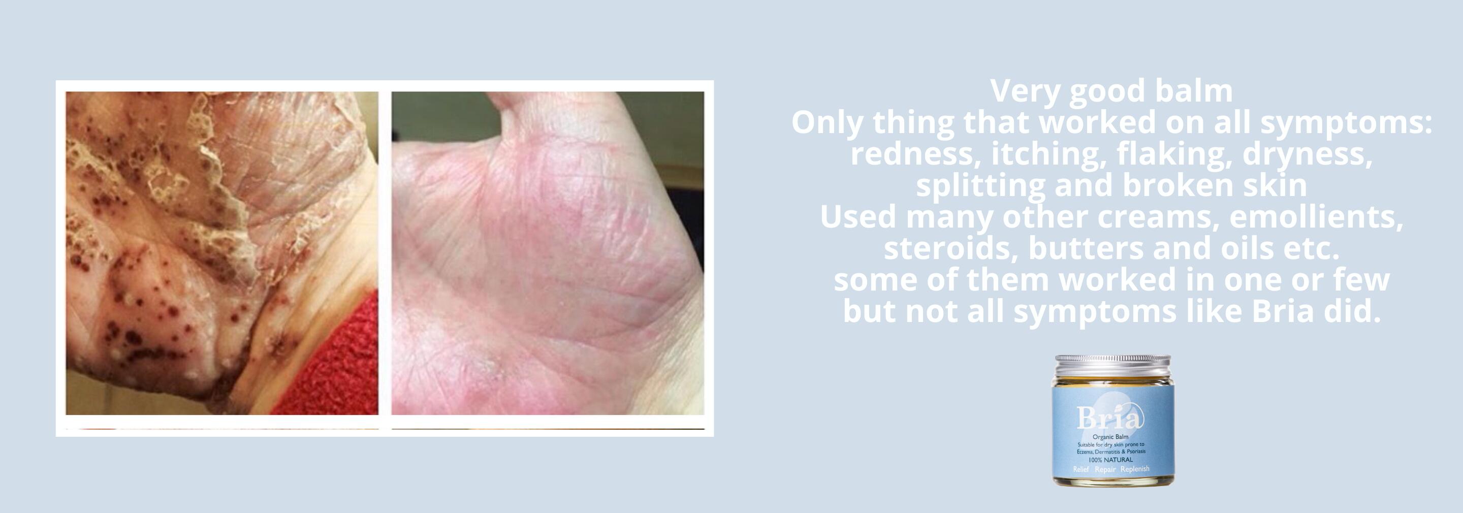 bria eczema